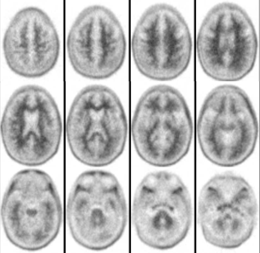 Case 3 | Indo-American Society Of Nuclear Medicine